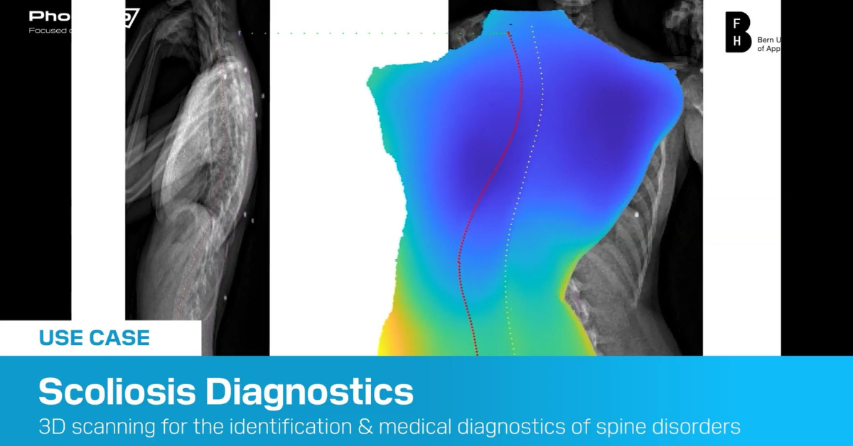 Case Studies: 3D scanning for scoliosis diagnostics | Zebra ...